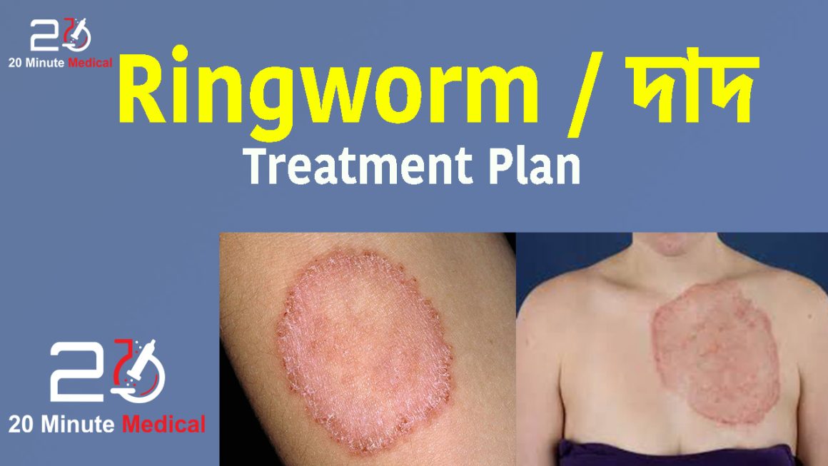 What is Ringworm? - 20 Minute Medical